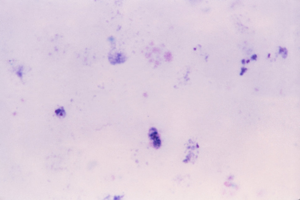 Public Domain Picture | This thick film Giemsa stained micrograph revealed a mixed P. falciparum ...