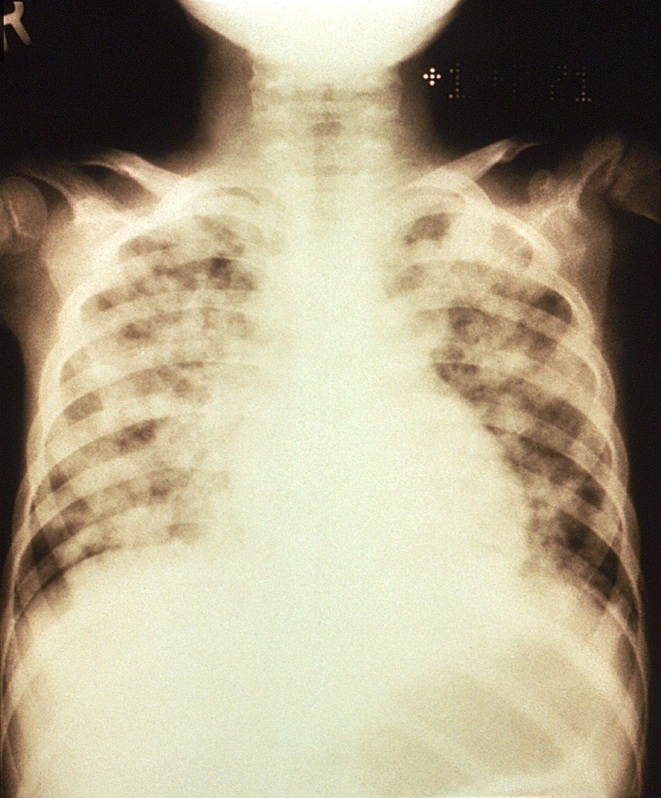 Public Domain Picture | This child's chest x-ray revealed the onset of ...